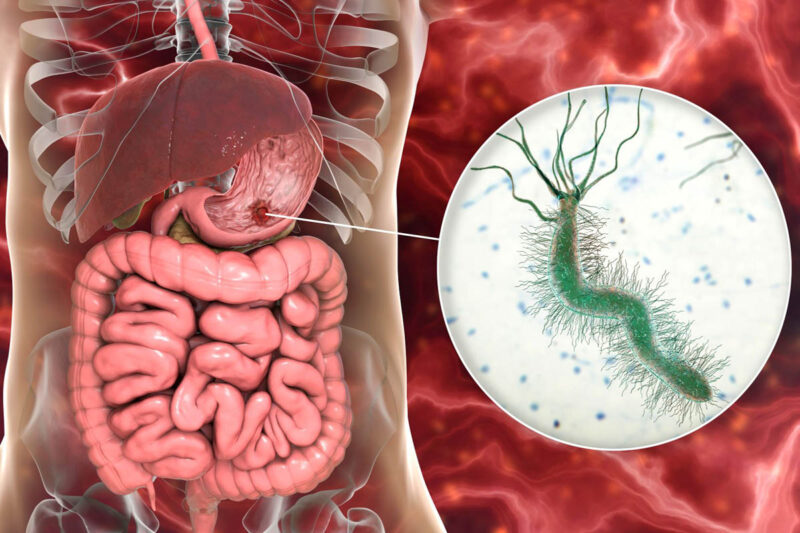 Helicobacter pylori: doctor explica síntomas y mitos - ATV